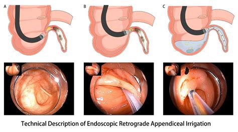 A Multicenter Propensity Score Matching Analysis Of Endoscopic