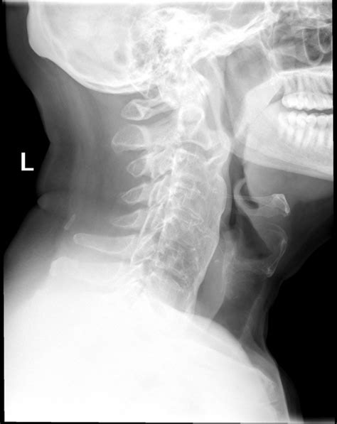Maxillary Hyperostosis Radiology At Melody Hanks Blog