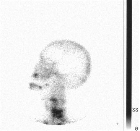 Technetium Bone Scan Showing Markedly Increased Tracer Activity In C5