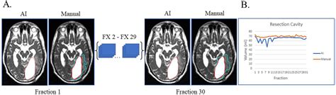 Figure 4 From A Deep Learning Approach For Automatic Segmentation During Daily Mri Linac