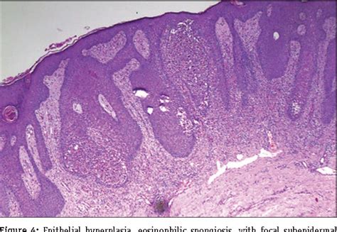 Figure 4 From Pyodermatitis Pyostomatitis Vegetans Semantic Scholar