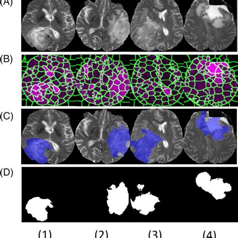 Slic Segmentation Results Row A Represents Different Brain T2 Images Download Scientific