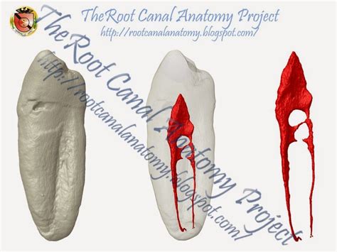 The Root Canal Anatomy Project Mandibular First Premolar Two Root Canals