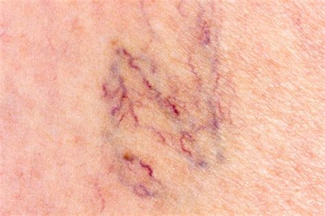 Spider Telangiectasia