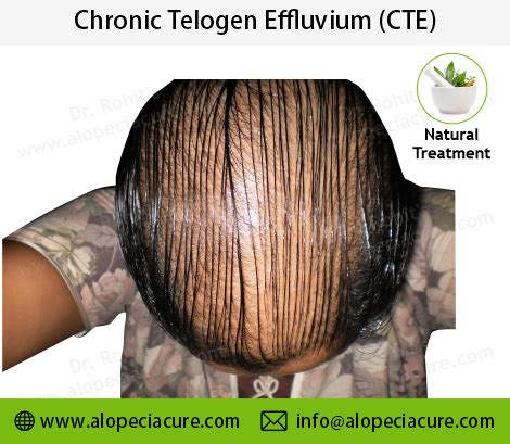 Telogen Effluvium Chronic Telogen Effluvium