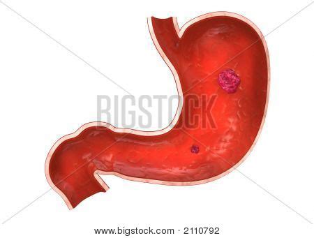 Stomach Ulcer Tumor Image Photo Free Trial Bigstock