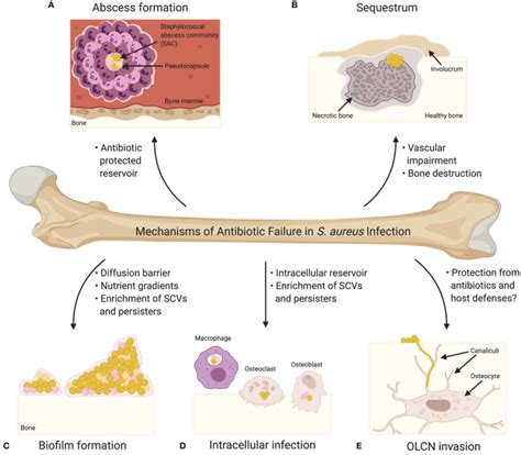 Staph Infection Lanced Severe MSSA Infection From Boil Lancing A Case Study Of Osteomyelitis