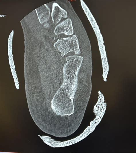 Cuboid Bone Fracture 🥴 R Medizzy