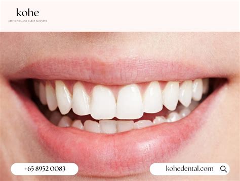 Doctor Is It Safe To Straighten Or Move Teeth Quickly • Kohe™ Dental