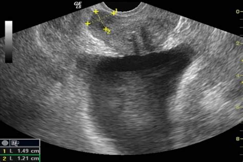 Hipertrofia Prostatica Benigna Diplomadomedico Com