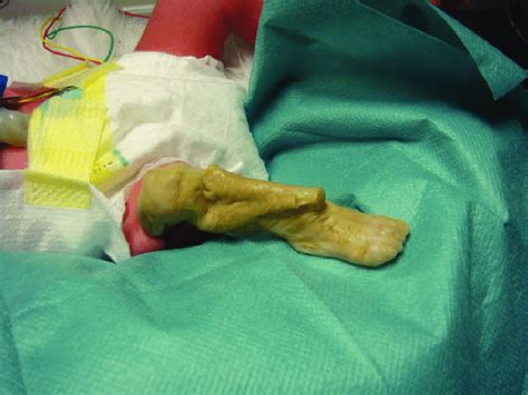 Picture Taken Shortly After Birth Showing Necrosis Of The Right Leg