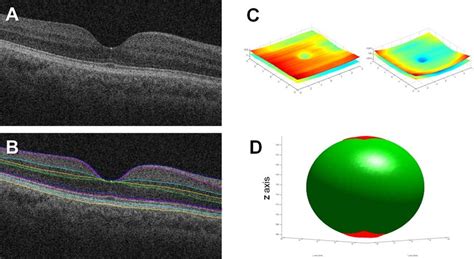 Overview Of Analysis Of Oct Images A Standard View Of One Download Scientific Diagram