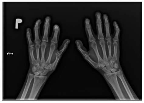 Imaging In Diagnosis Of Systemic Sclerosis PMC