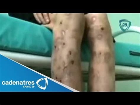 Efectos De La Droga Cocodrilo