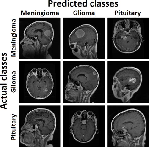 Figure 2 From Brain Tumor Segmentation From Multi Spectral Mri Records
