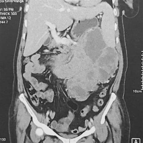 Axial Cut Of A Ct Scan Showing A Large Gastric Mass Download Scientific Diagram