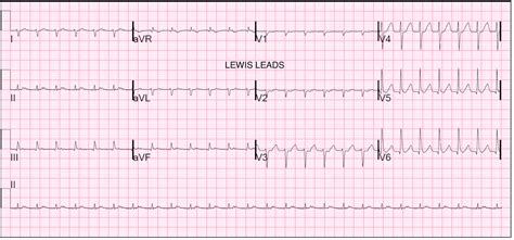 Dr Smiths Ecg Blog
