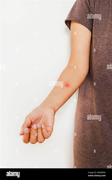 Shingles Zoster Or Herpes Zoster Symptoms On Womans Arm Isolated Stock