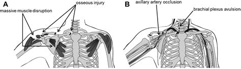 Scapulothoracic Dissociation Orthopedic Clinics