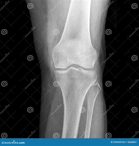 Knee Joint X Ray Ap View Stock Image Image Of Drawing 296365763