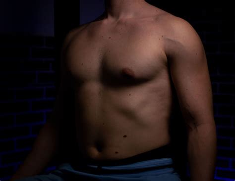 What Is Pectus Excavatum 2024 How To Improve It And More