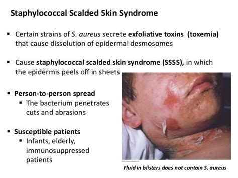 Staphylococcal Medical Surgical Nursing Aspirants