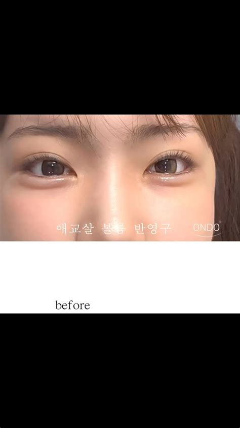 입술반영구 애교살반영구 인중축소 결눈썹 반영구수강 시술 직후 자연스러운 Ondo 애교살 반영구 기법 👏🏻👏🏻