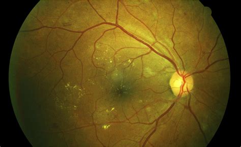 Diabetic Macular Oedema Dmo An Introduction Community Eye Health