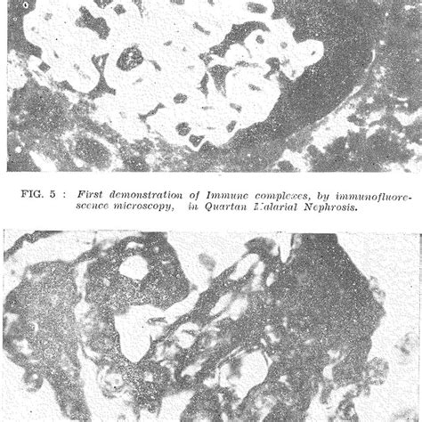 Segment Of A Glomerulus Showing Capillary Wall Thickening And Segmental Download Scientific