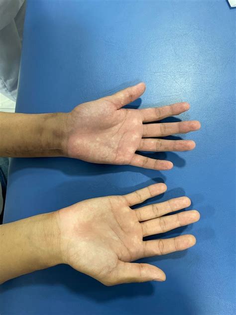 Hoang Trinh On Linkedin A Case Of Median Nerve Damage Causing