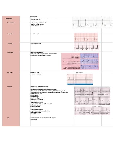 Ekg Abnormals Ekg Abnormalities Chart Origin Of Impuse Sa Node Atrial Cells Av Nodes Or