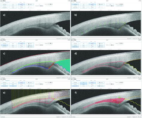 An Illustrative Example Of The Segmentation Of The Ciliary Muscle A