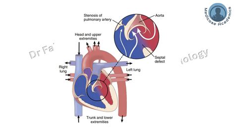 Heart Valves And Heart Sounds Congenital And Valvular Heart Diseasepdf