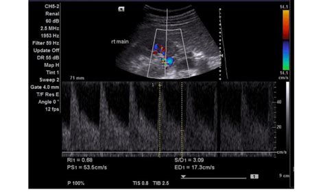 Calculation Of Renal Resistive Index Rri From Spectral Doppler