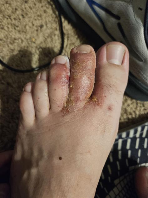 Anyone Else Get These Infections On Their Toes Because Of The Sweating Warning Pretty