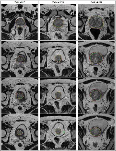 deep learning for prostate segmentation