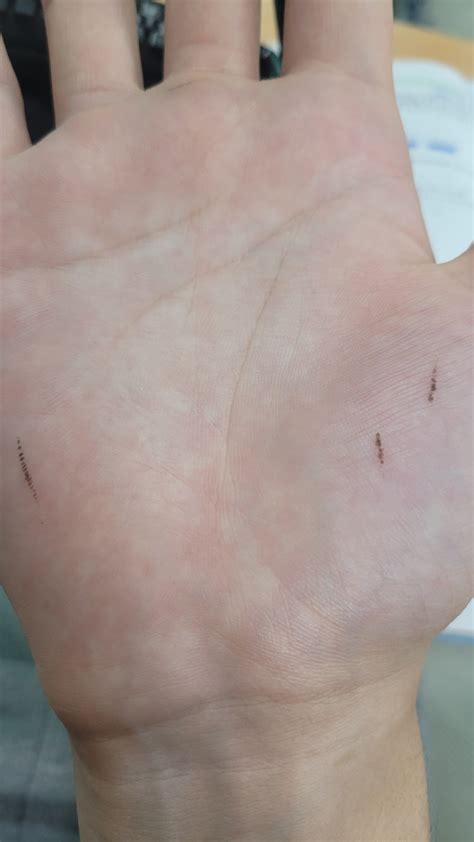 제 손바닥에 난 볼펜자국 모양의 점 피부암인가요 지식in