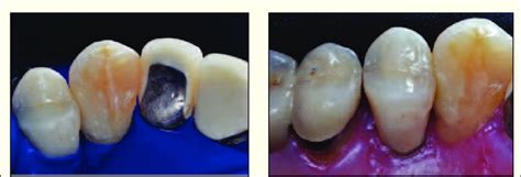 The Class Iii Composite Resin Restoration Renamel Nano Cosmedent