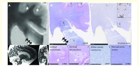 Diffuse T 2 Hyperintense Lesion In The Splenium Of The Corpus