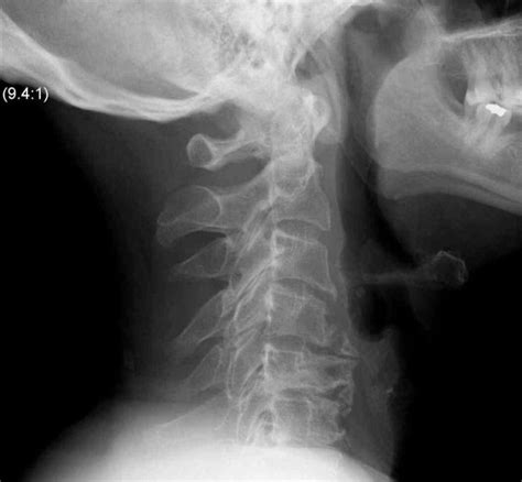 Secondary To Exaggerated Flexion Or Extension Because Of Direct Trauma