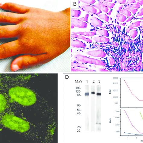 pdf a dermatomyositis and scleroderma overlap syndrome with a