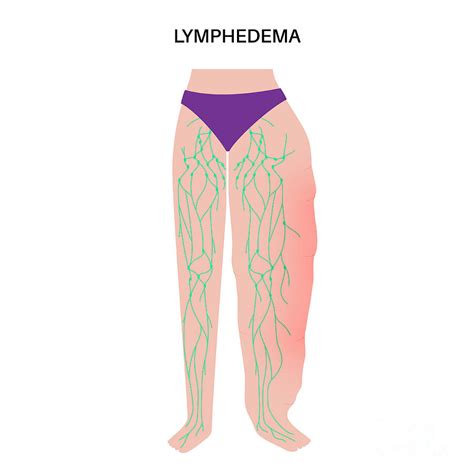 Lymphoedema Leg Swelling 2 By Science Photo Library