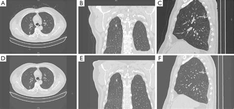 three dimensional reconstruction of computed tomography ct scans
