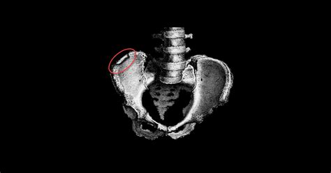 Hip Pointer Osteomag