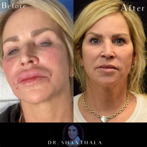Dangers Of Lip Fillers Avoid Duck Lips Shanthala Md Laser And Aesthetic