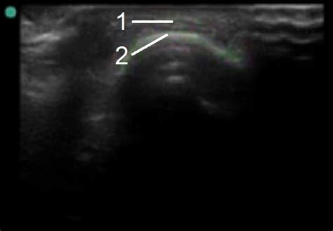 Foot And Ankle Mtp Joint Anatomy Short Axis Image Sonosite Institute For Point Of Care Ultrasound