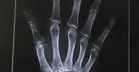 My Right Hand Thumb Dislocation Album On Imgur