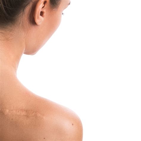 Premium Photo Woman With A Scar On Her Shoulder