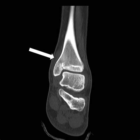 Preoperative Computed Tomography Ct Shows A Vertical Fracture Line In
