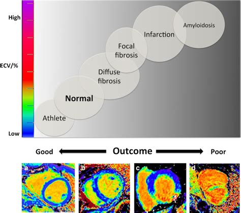 Myocardial Extracellular Volume Quantification By Cardiovascular Magnetic Resonance And Computed